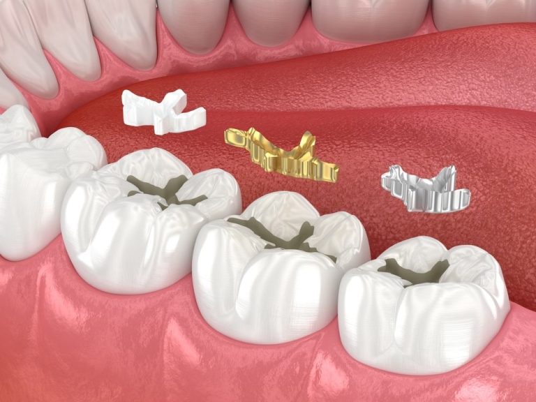 5 Reasons Why Tooth-Colored Fillings Are the Superior Choice